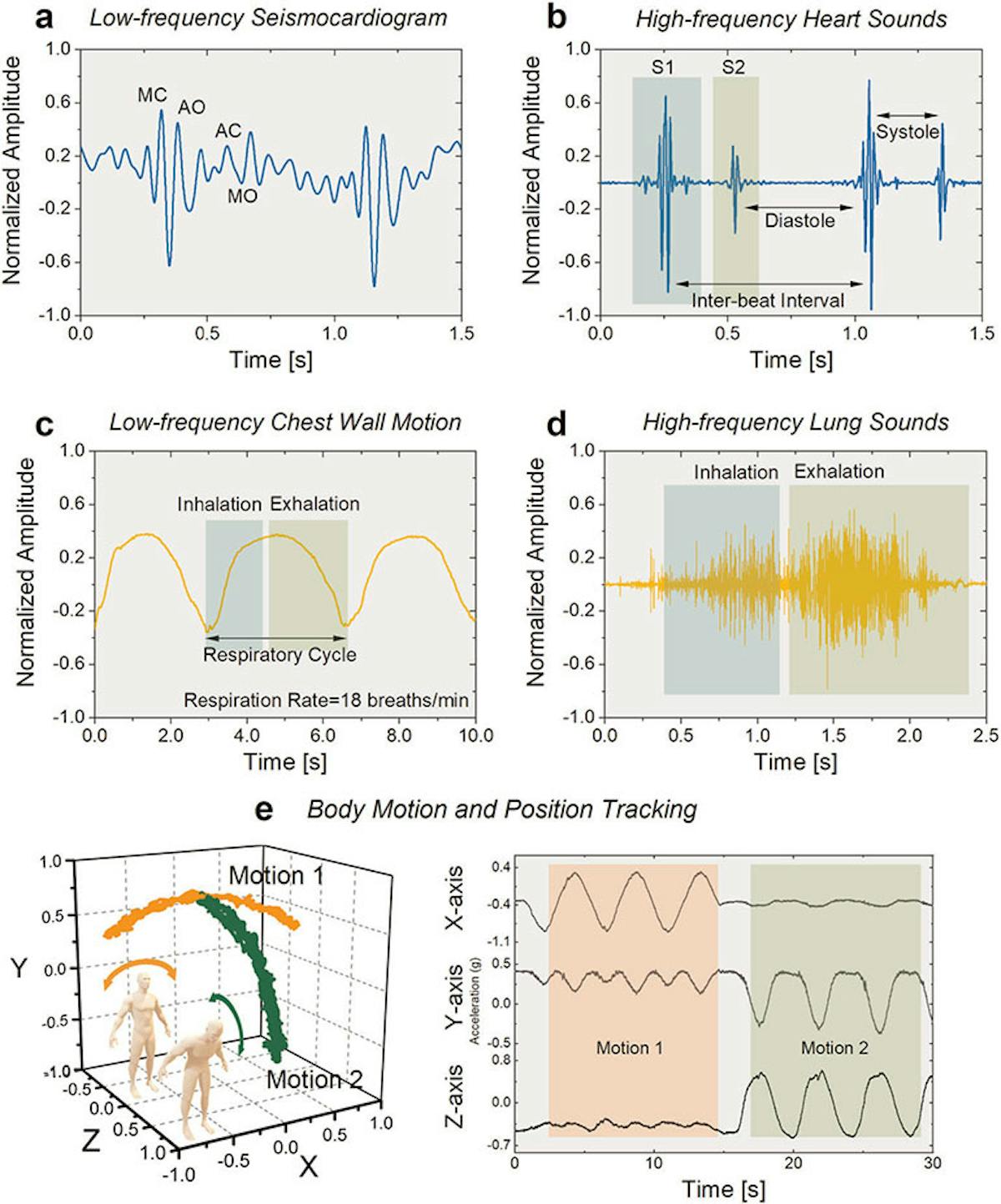 MEMS-Like Accelerometer-Microphone Captures Lung, Cardiac “Vibe” for ...